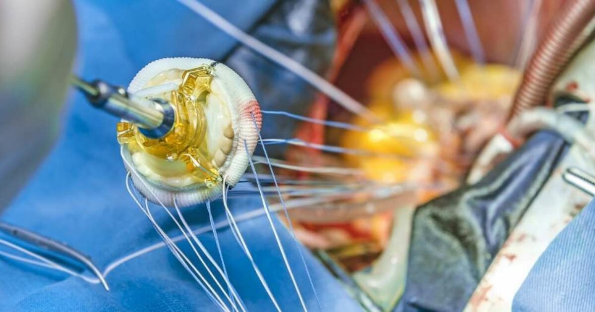 UMC Utrecht plaatst eerste biologische hartklep | Change Inc.